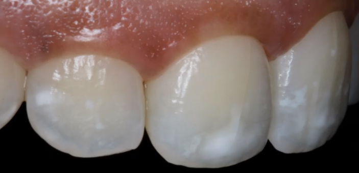 What is Enamel Microabrasion? Is Microabrasion safe for teeth?