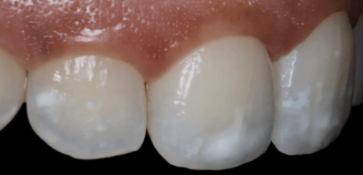 What is Enamel Microabrasion? Is Microabrasion safe for teeth?