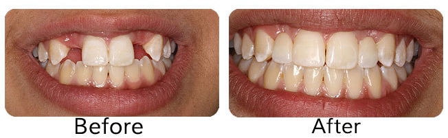 Alternate missing teeth replacements | Ismile